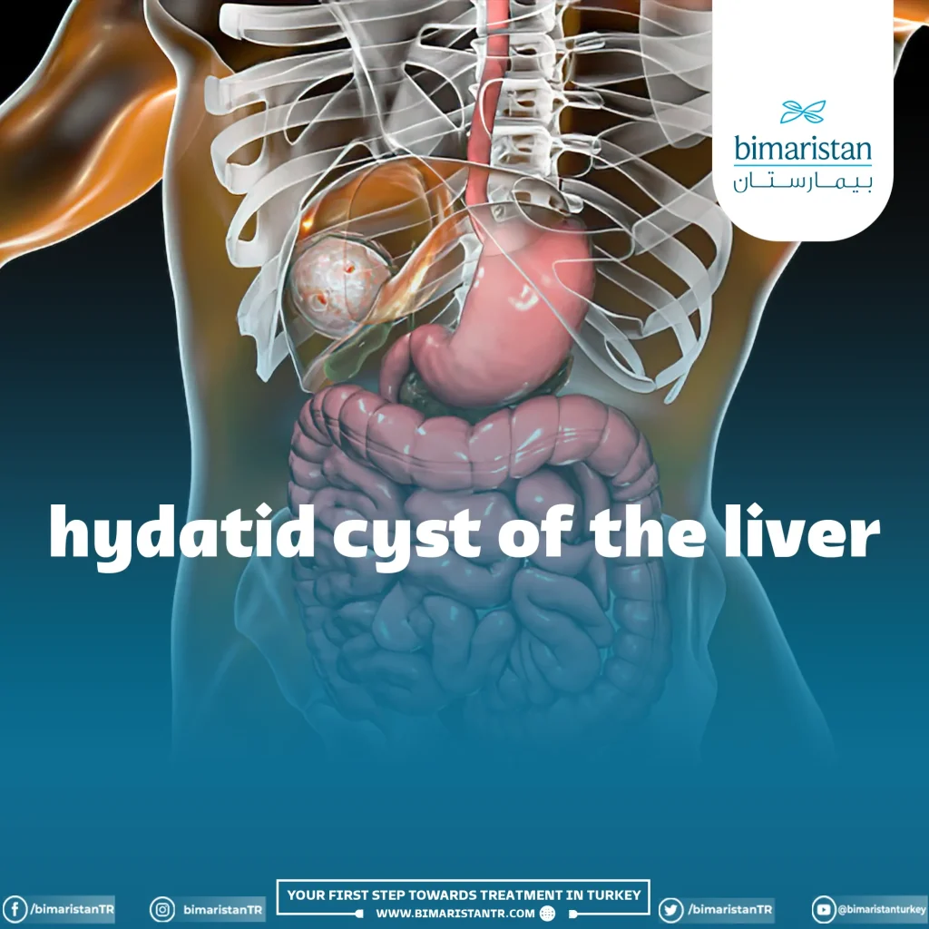 Liver Hydatid Cyst Treatment in Turkey - بيمارستان
