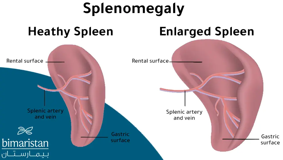 Pediatric Splenomegaly Treatment in Turkey - Bimaristan