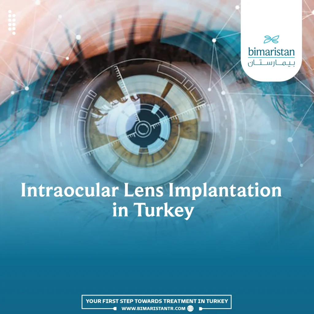 Lens Replacement Surgery in Turkey 2024 - بيمارستان
