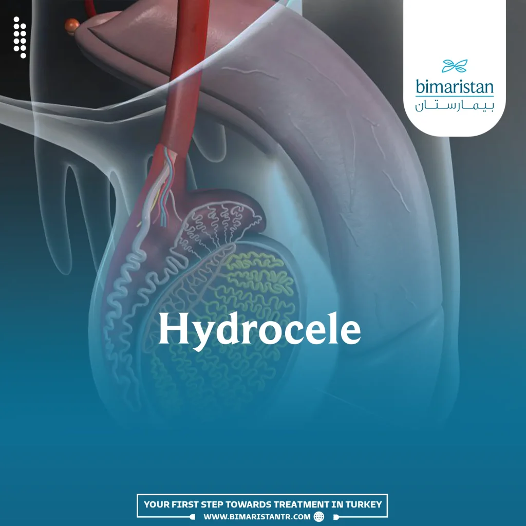 Hydrocele; Symptoms and its Treatment in Turkey - Bimaristan
