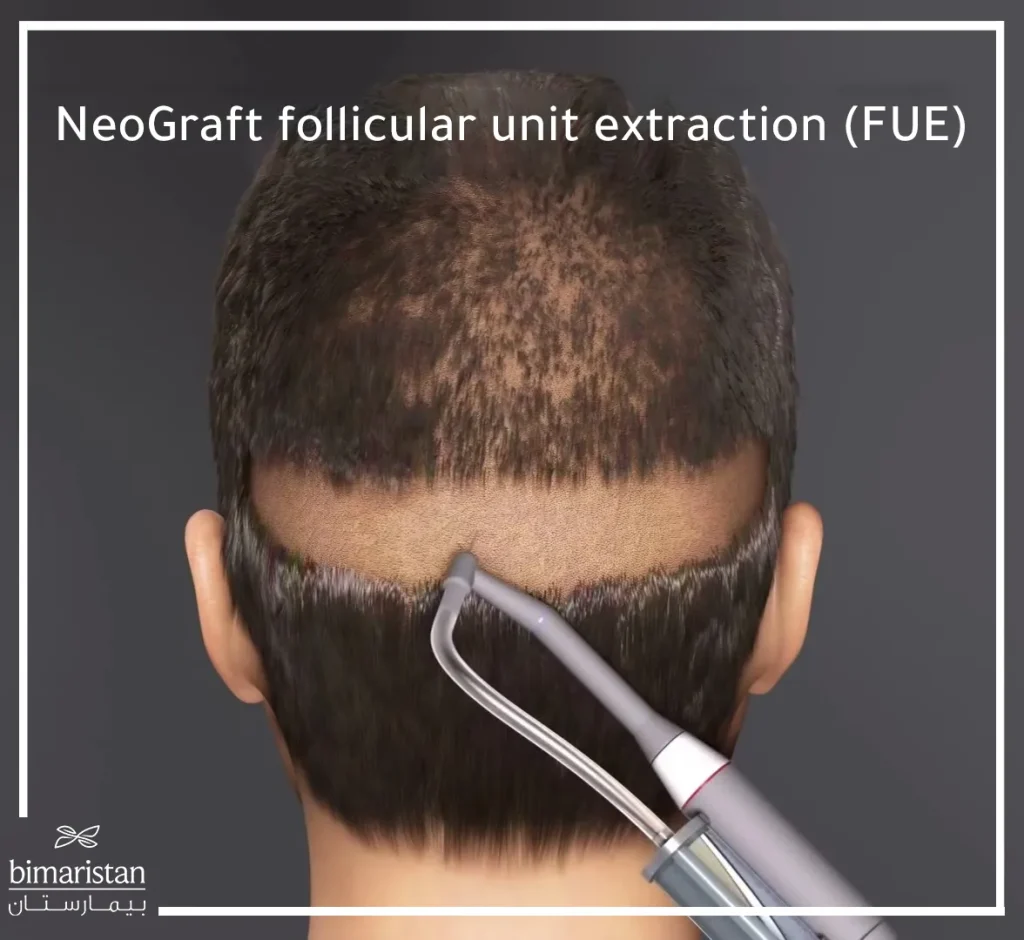NeoGraft Hair Transplant in Turkey