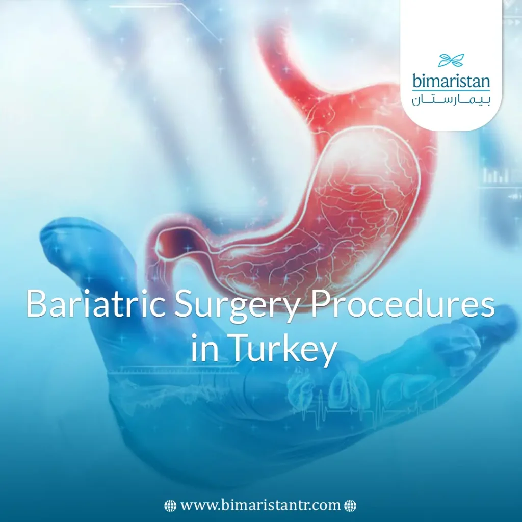 Types of Bariatric Surgery in Turkey - Bimaristan