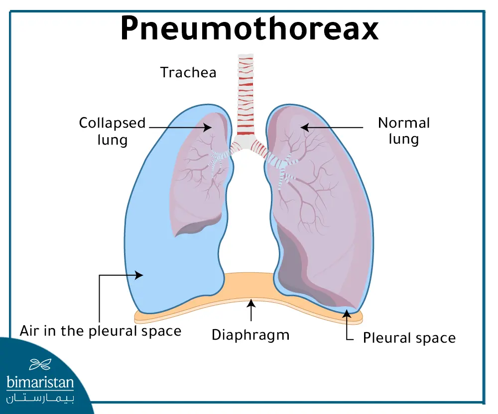 Pneumothorax: Symptoms and Treatment