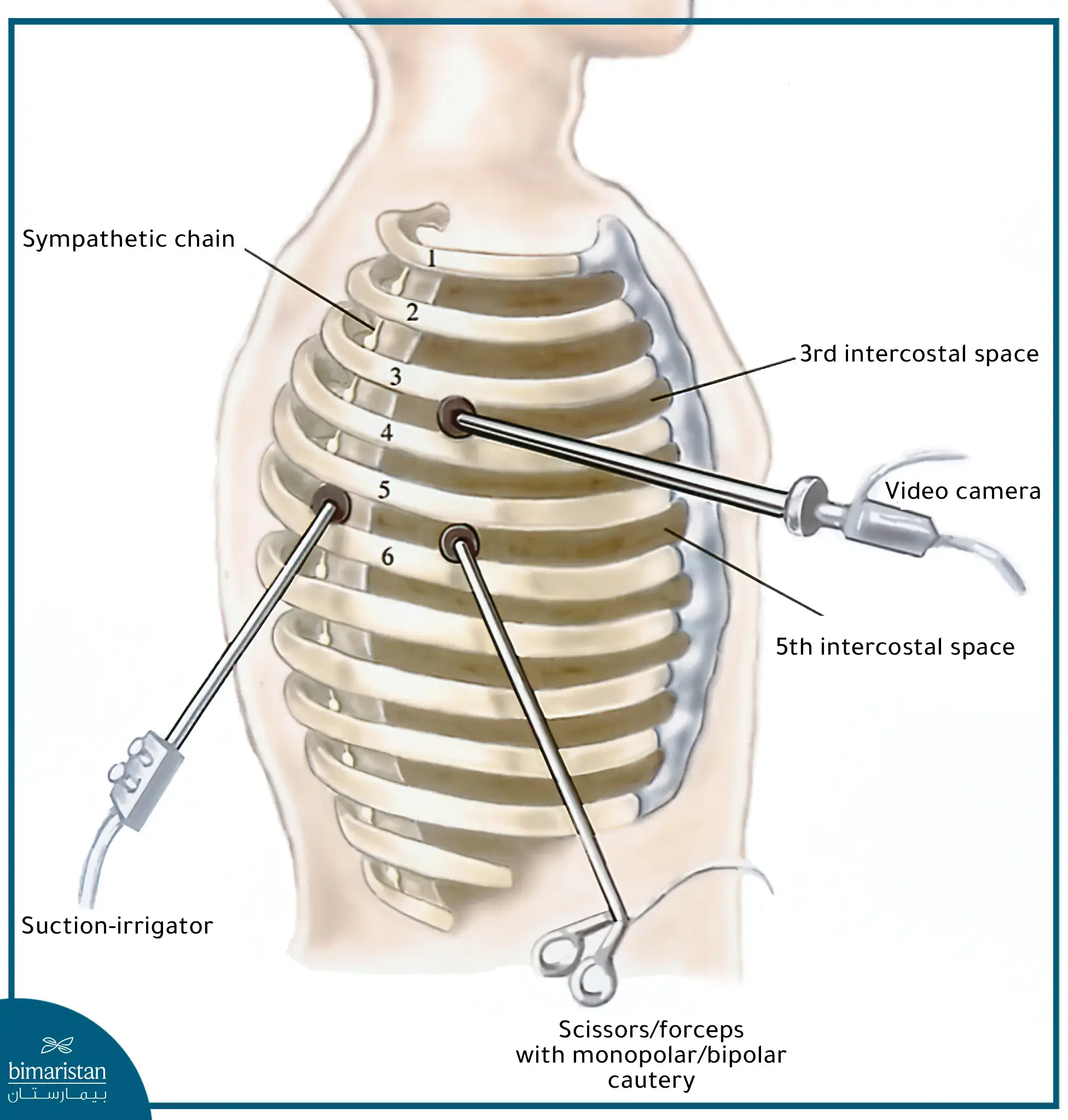 Thoracoscopic Sympathectomy Hyperhidrosis Treatment 2025
