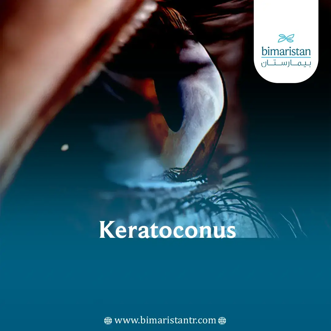 keratoconus | symptoms and treatment methods - Bimaristan
