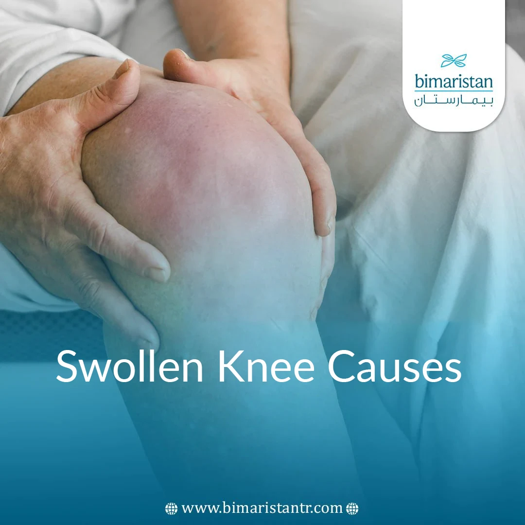 Causes of Swollen Knee and Treatment in Turkey - بيمارستان