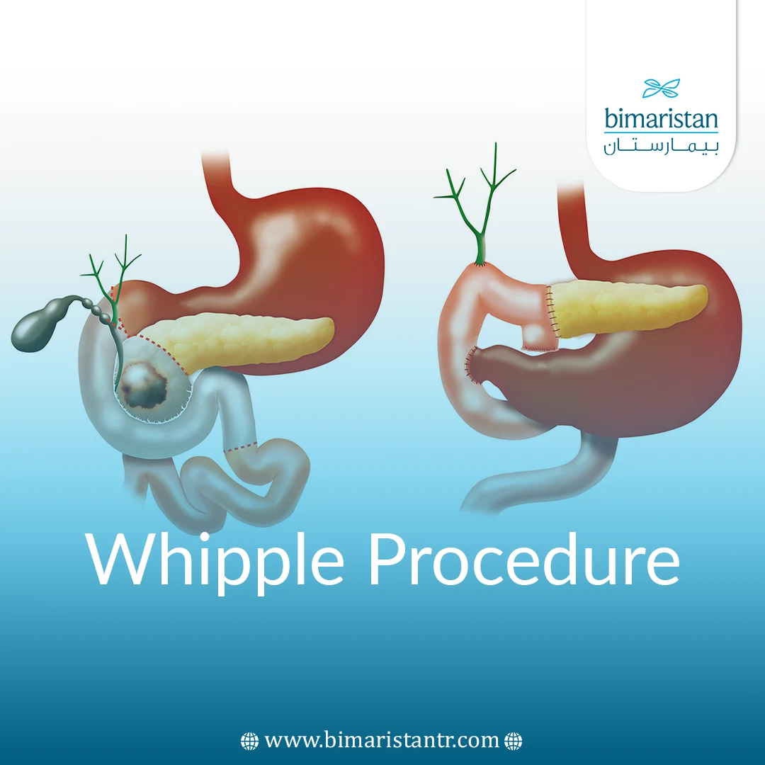 Whipple Procedure for Pancreas and Duodenum Tumors