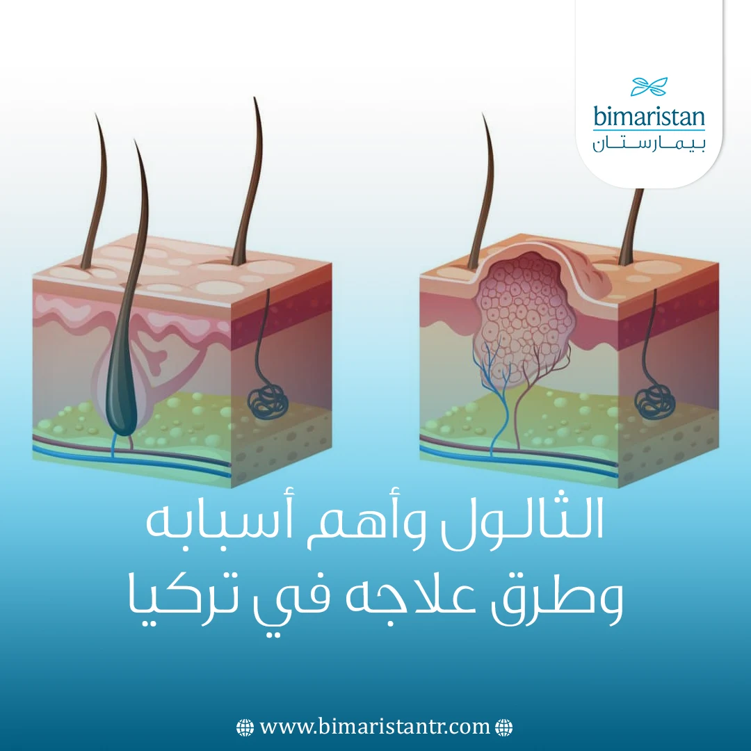 الثالول وأهم أسبابه وطرق علاجه - بيمارستان