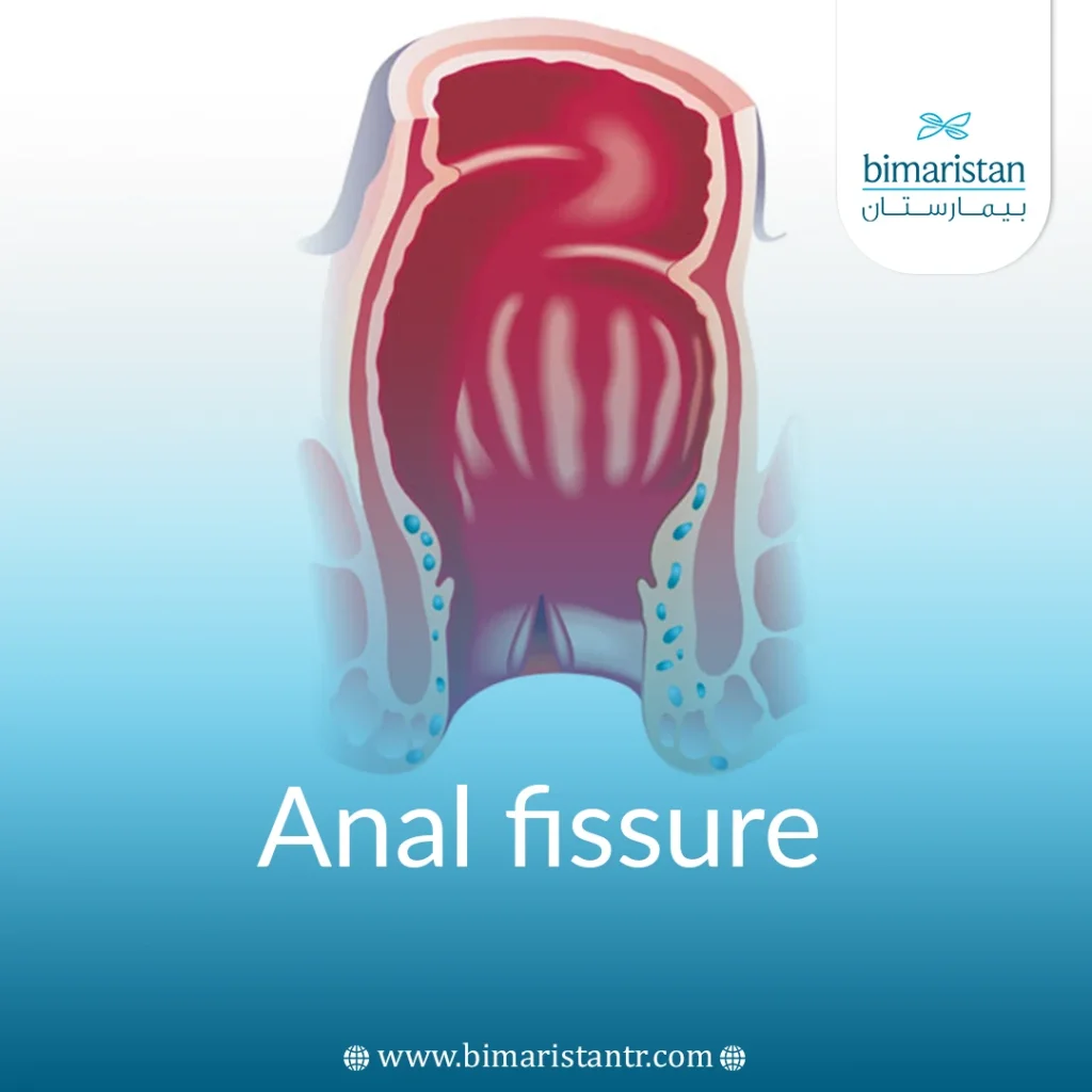 Anal Fissure: Main Causes and Treatment Methods - Bimaristan