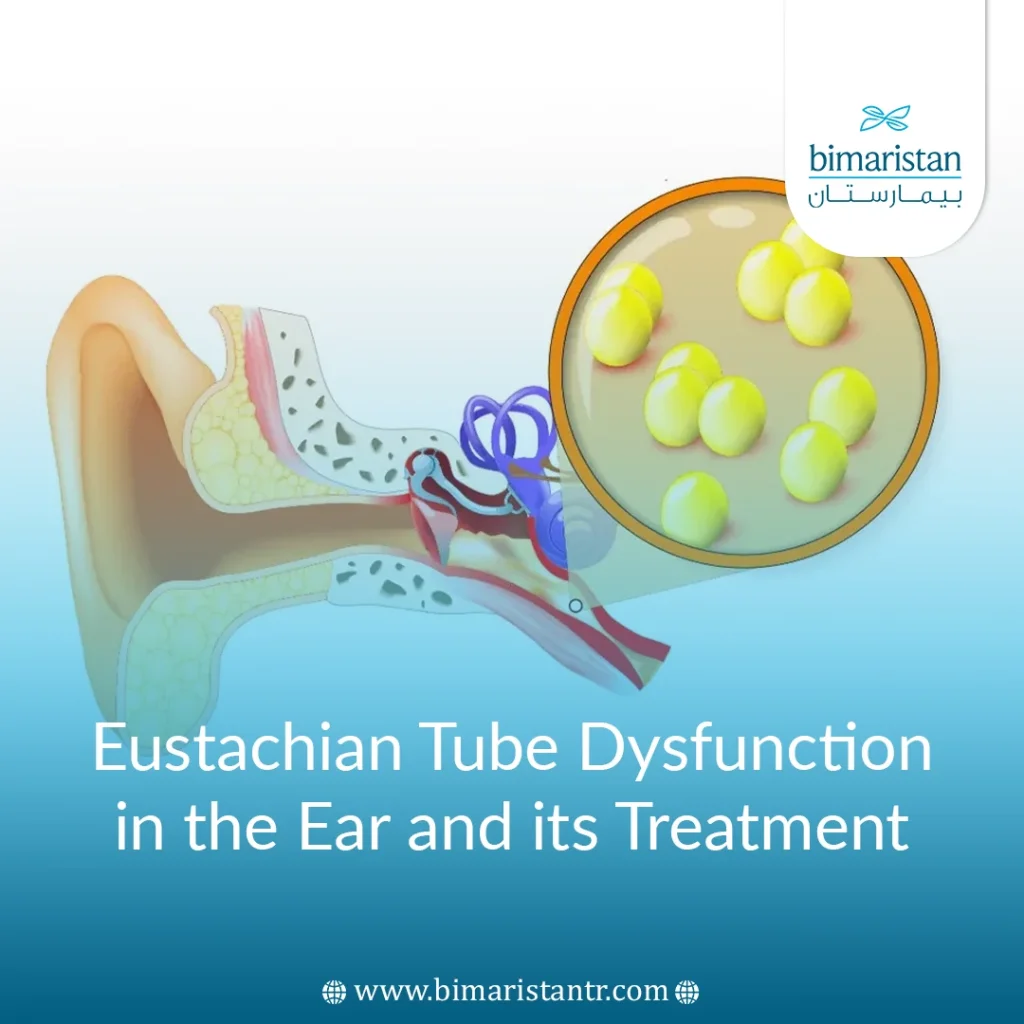 Eustachian Tube Dysfunction in the Ear and its Treatment