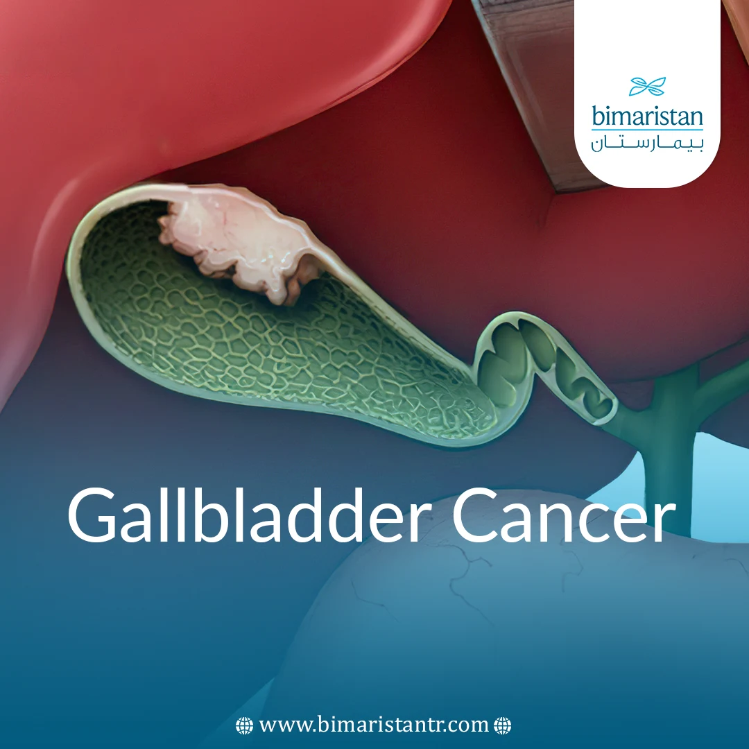 Gallbladder Cancer Symptoms and Treatment in Turkey