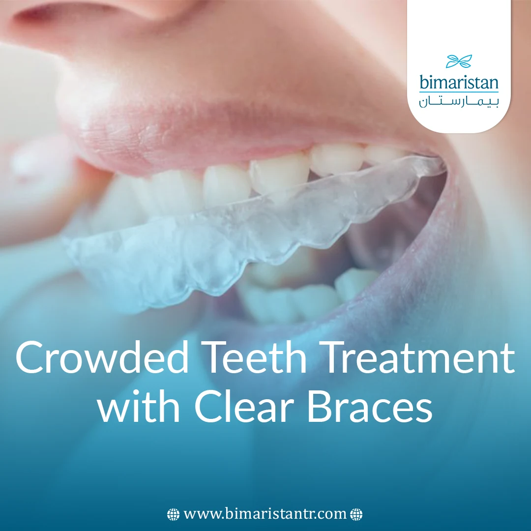 Crowded Teeth Treatment with Clear Braces in Turkey