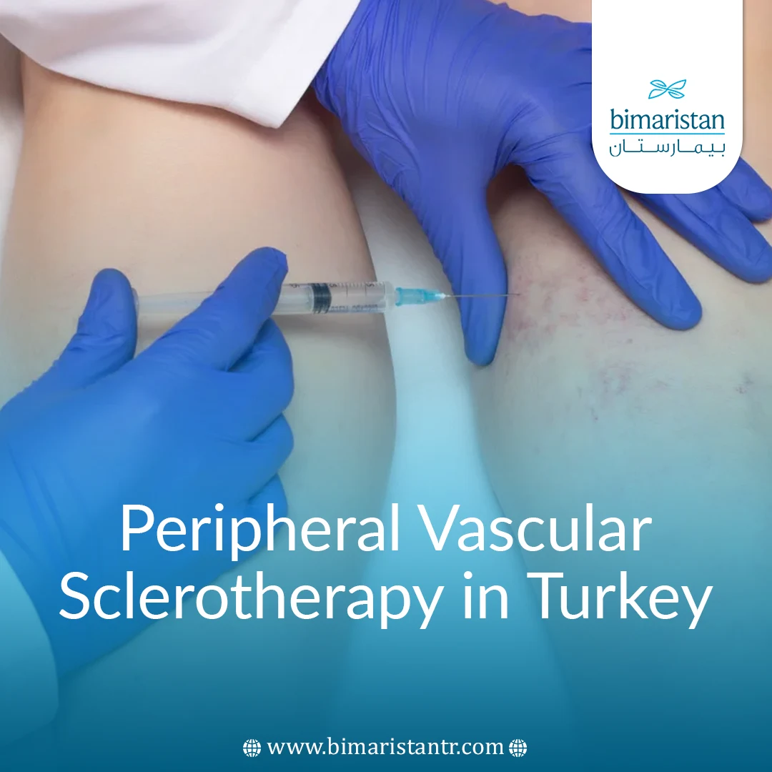 Peripheral Vascular Sclerotherapy in Turkey in 2025