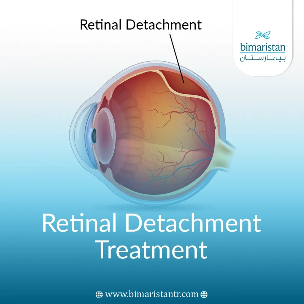 Retinal Detachment Treatment in Turkey - Bimaristan