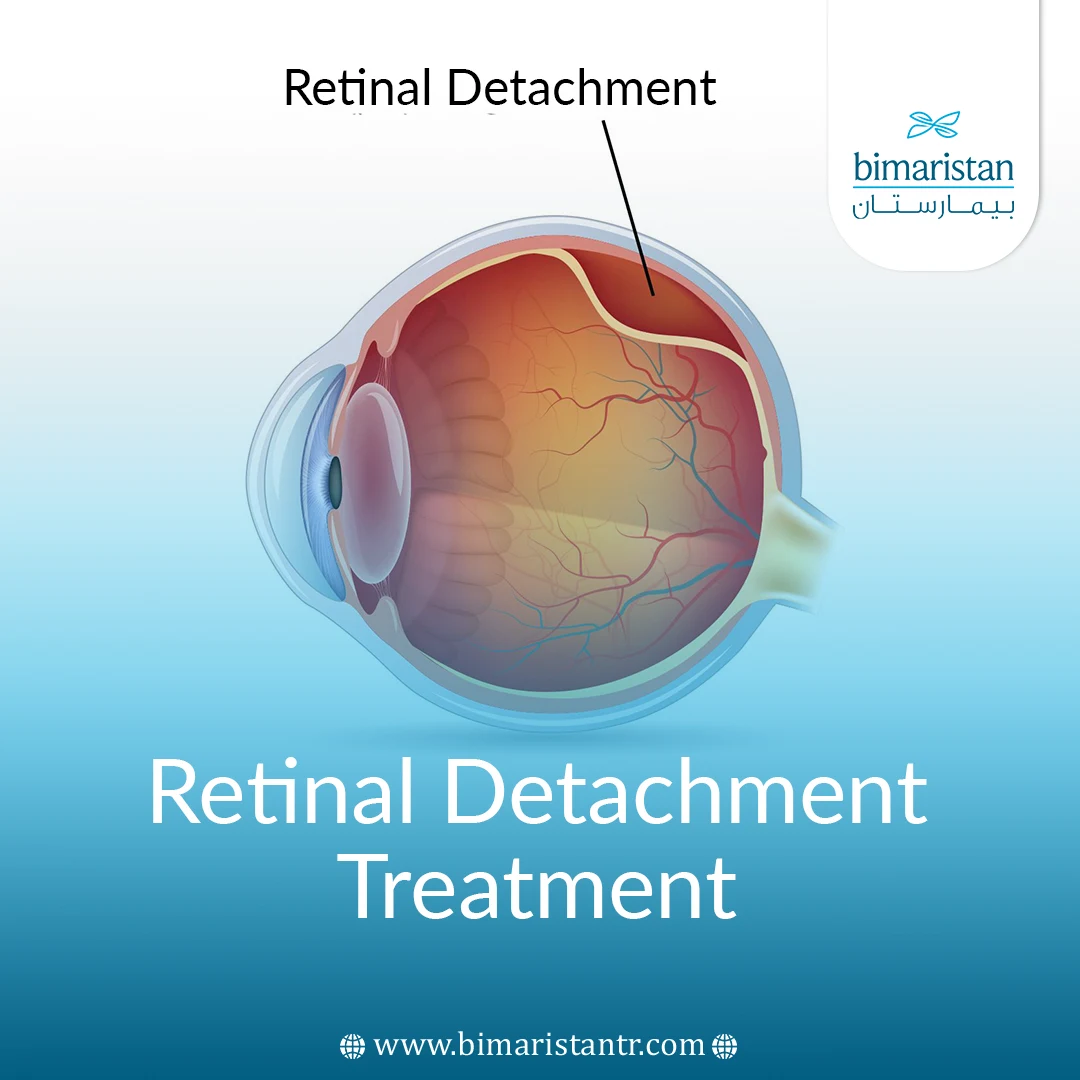 Retinal Detachment Treatment in Turkey - Bimaristan