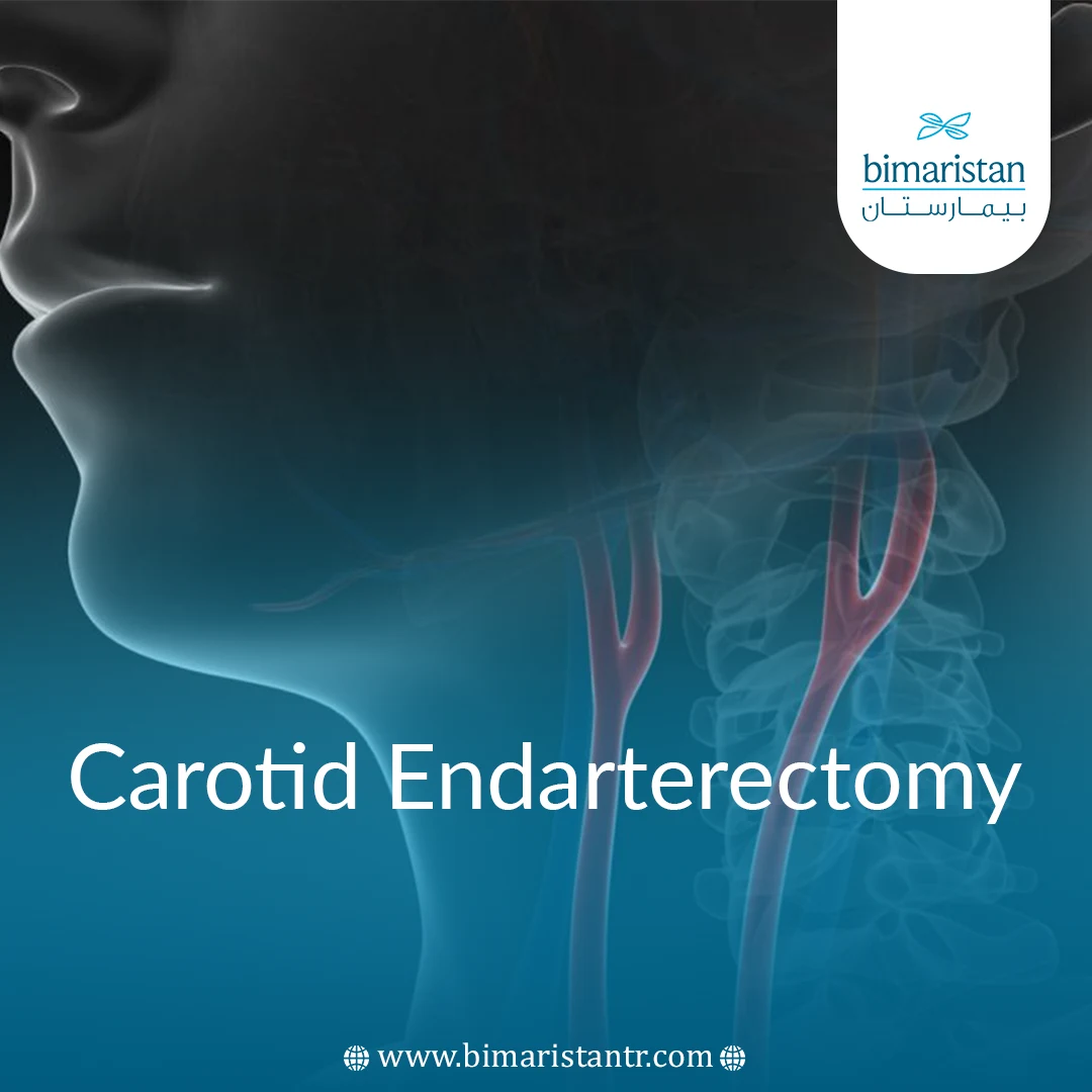 Carotid Endarterectomy in Turkey - Bimaristan