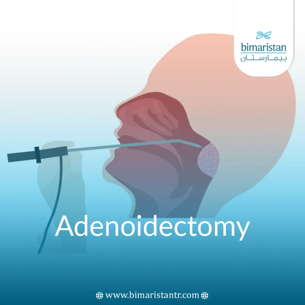 Adenoidectomy: All You Need to Know - Bimaristan