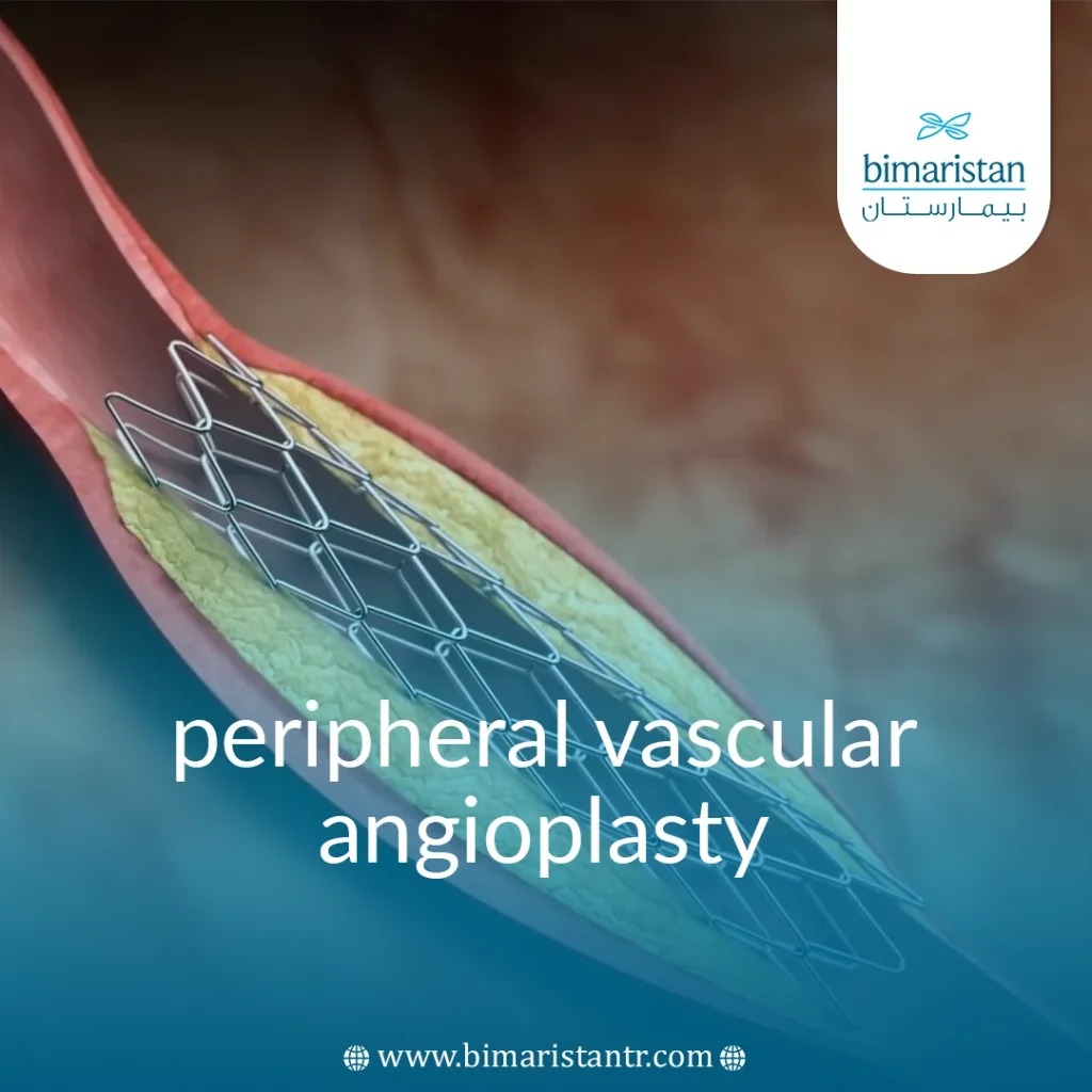 Peripheral Vascular Angioplasty in Turkey - Bimaristan