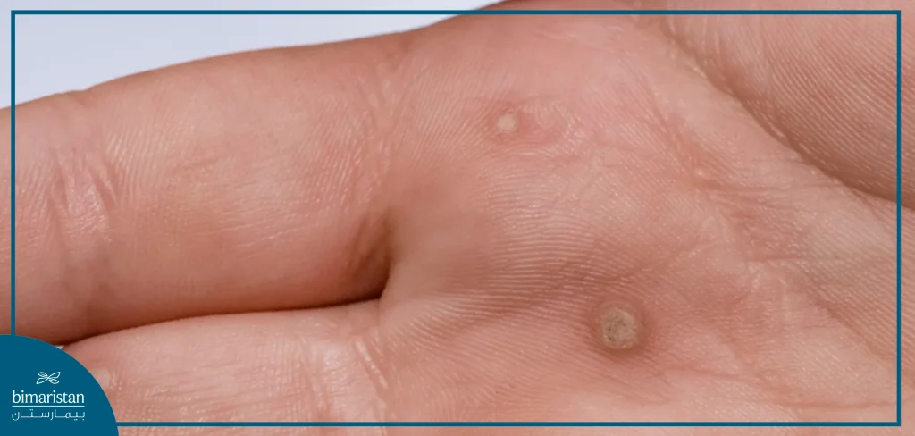 Warts and its leading causes and treatment methods - بيمارستان