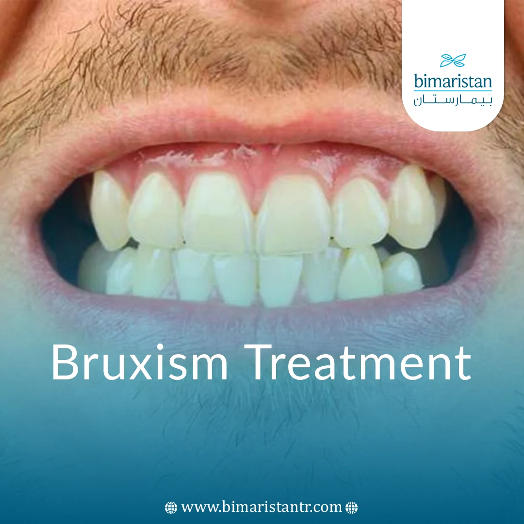 Bruxism Treatment | Causes of Day and Night Teeth Grinding