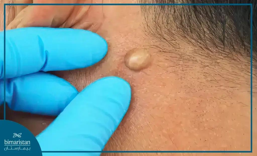 Causes and Symptoms of Epidermoid Cyst - Bimaristan