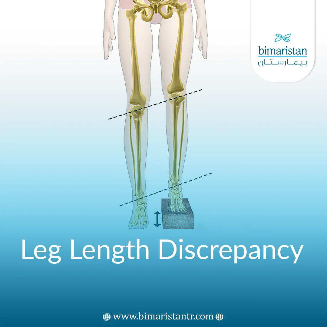 Leg Length Discrepancy; Symptoms and Treatment Method