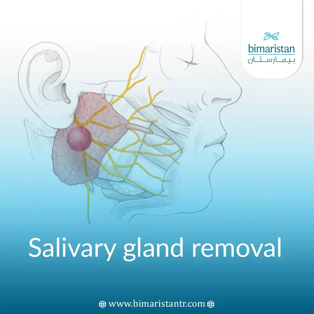 Salivary Gland Removal Surgery in Turkey - Bimaristan