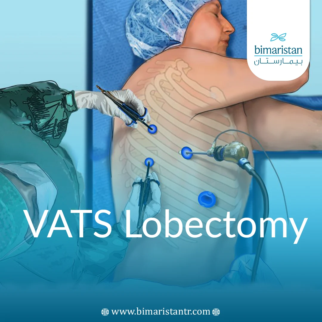 VATS Lobectomy in Turkey - Bimaristan