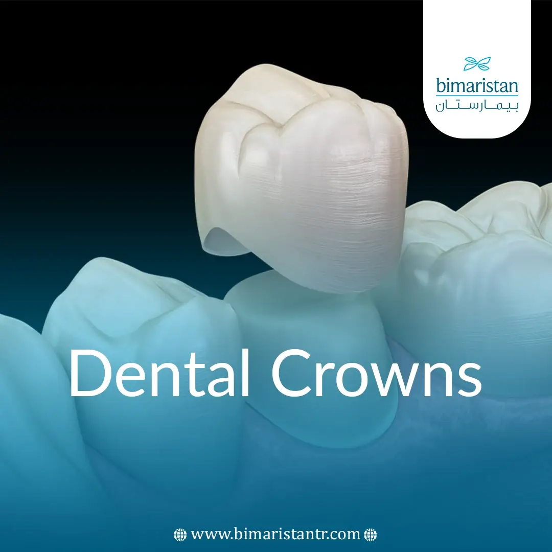 Dental Crowns: Procedure in Turkey - Bimaristan