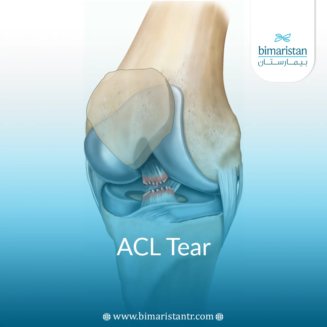 ACL Tear and Its Treatment