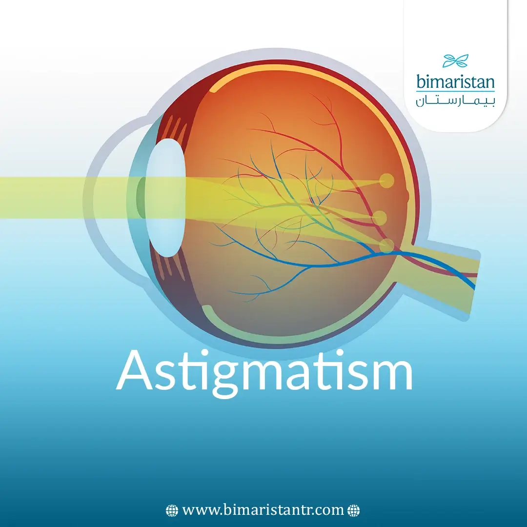 Astigmatism Treatment in Turkey - Bimaristan