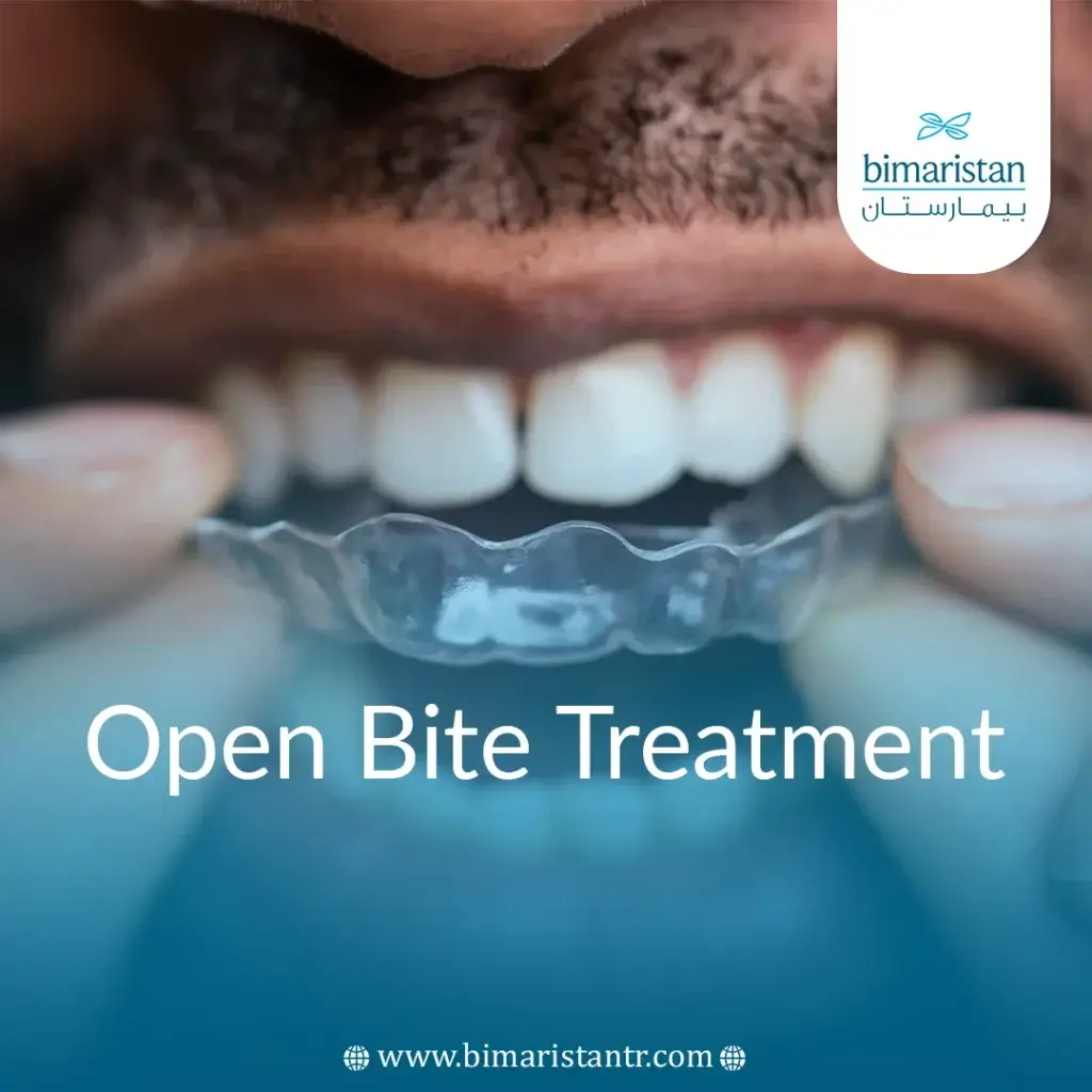 Open Bite Treatment with Clear Aligners in Turkey-Bimaristan