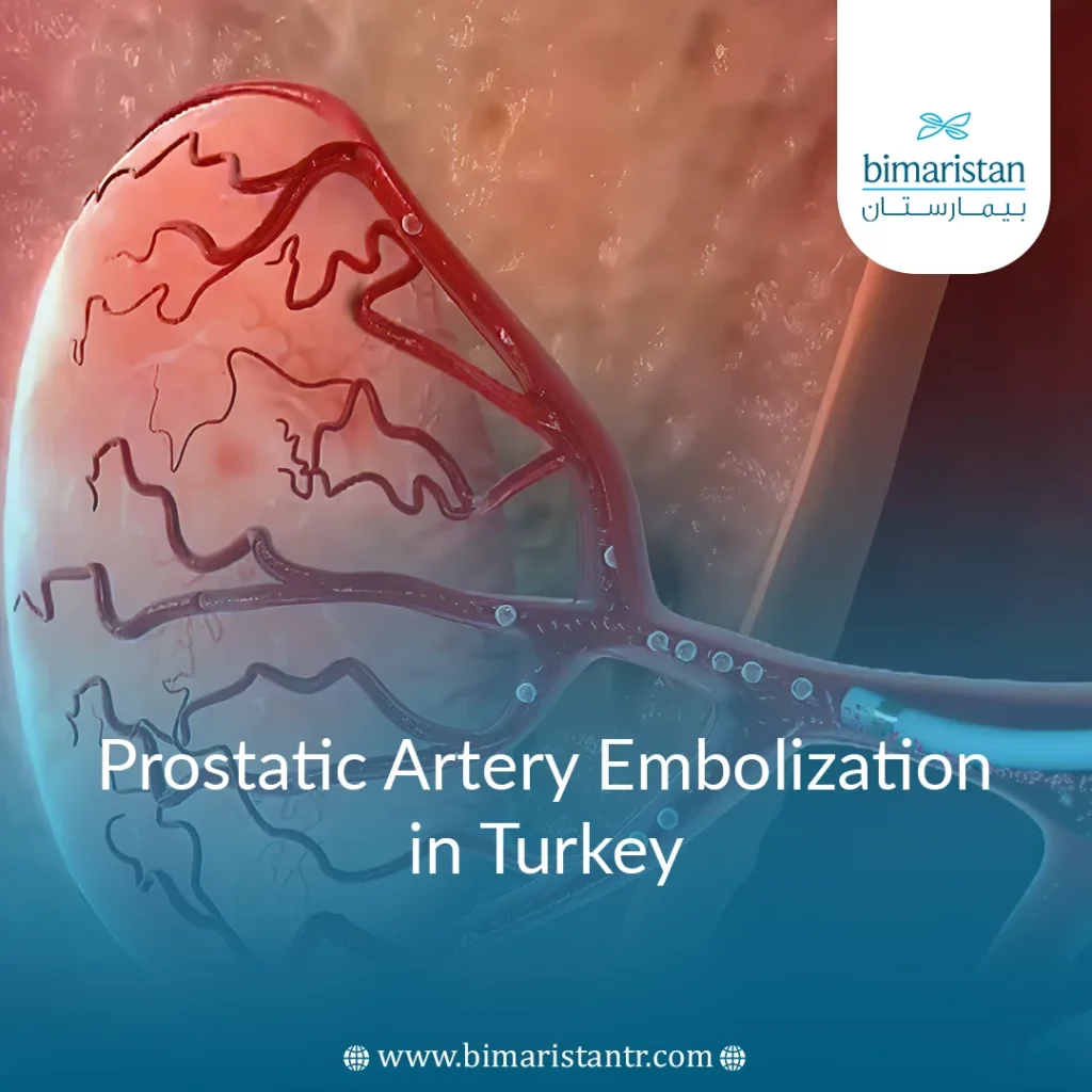 Prostatic Artery Embolization in Turkey - بيمارستان