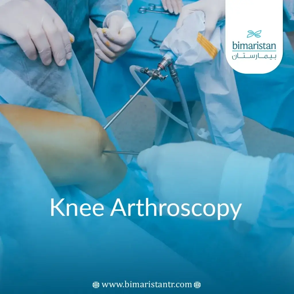 Knee Arthroscopy Treatment in Turkey - Bimaristan