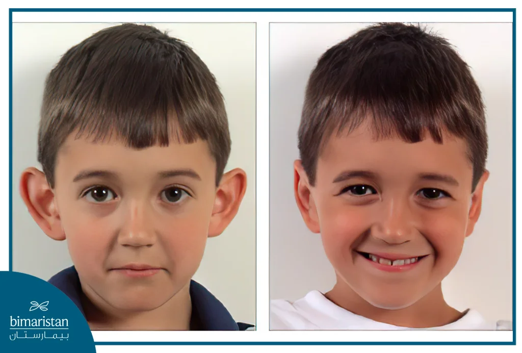Bat Ears Treatment Without Surgery Prominent Ear Cosmetic