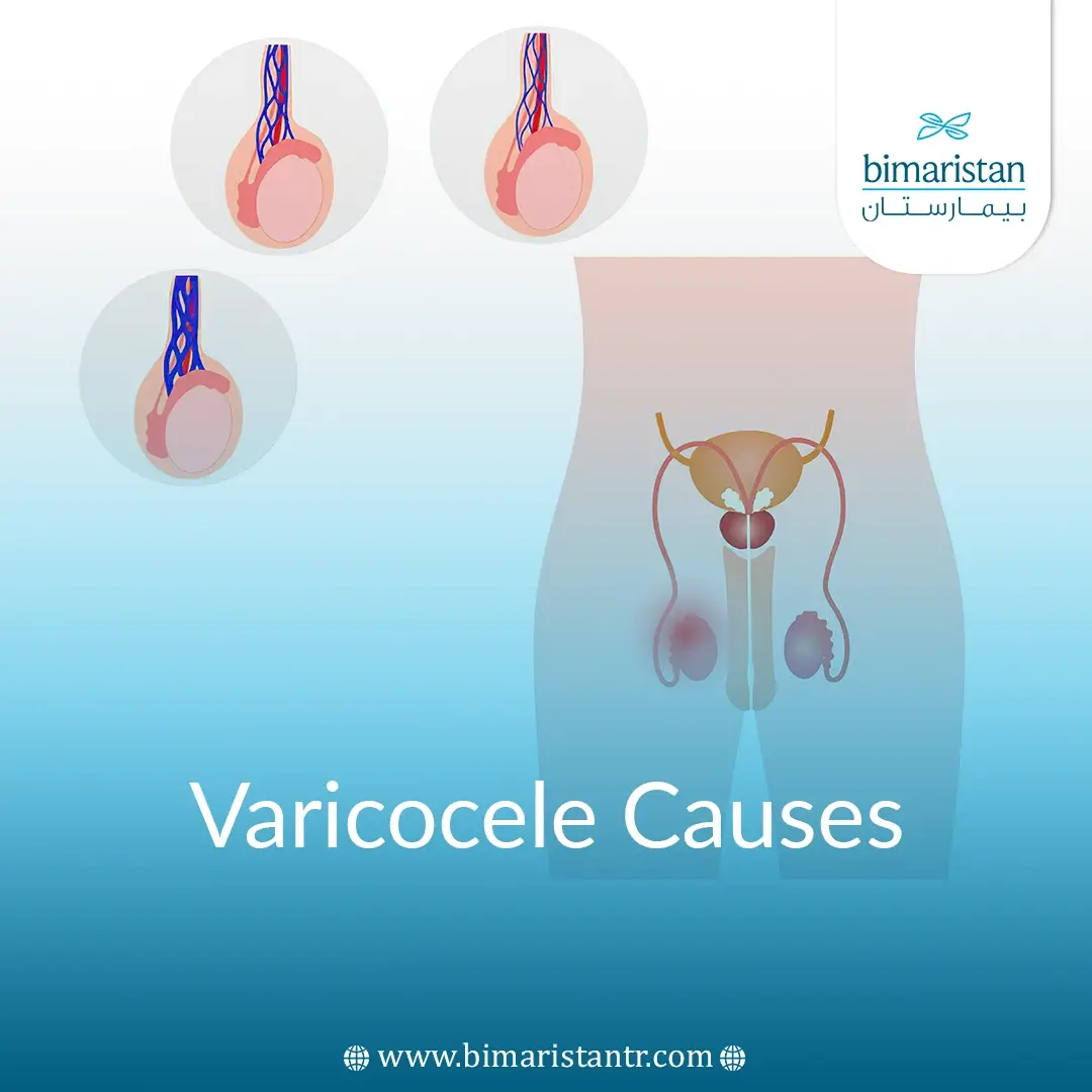 Varicocele Causes: Prevention and Treatment - Bimaristan