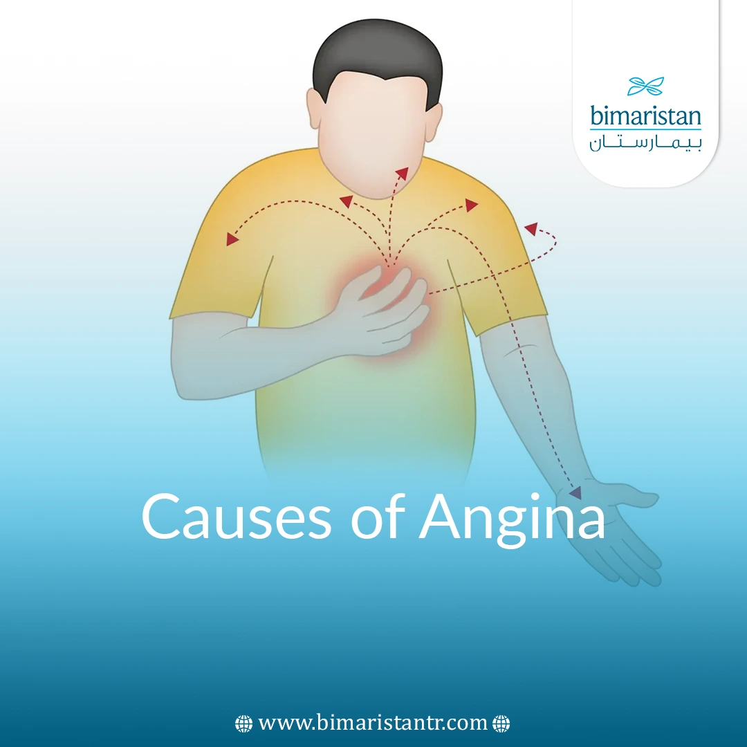 Causes of angina: factors, symptoms and warnings