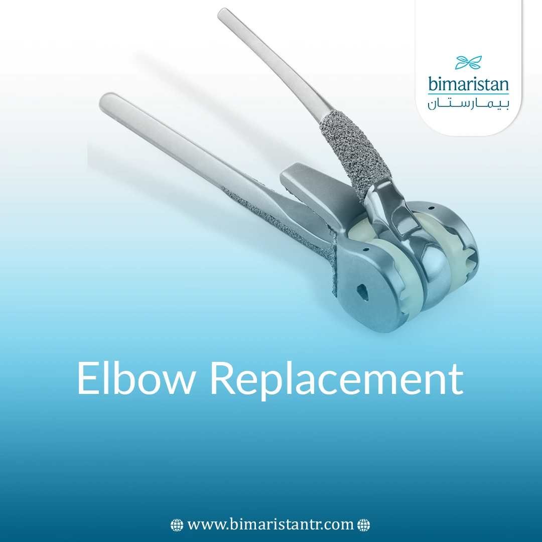 A Complete Guide to Elbow Replacement Surgery in Turkey