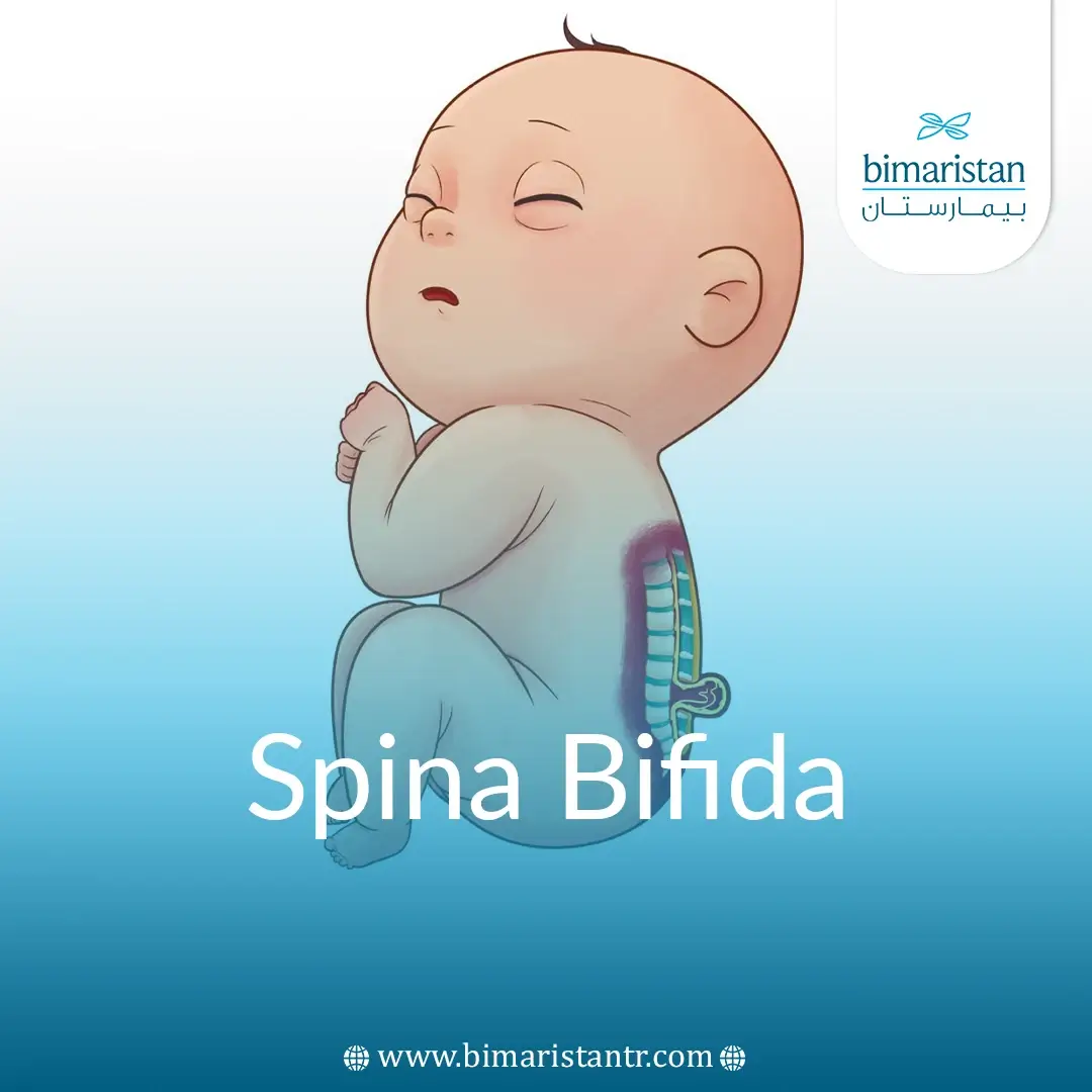 Spina Bifida Treatment Options in Turkey - Bimaristan