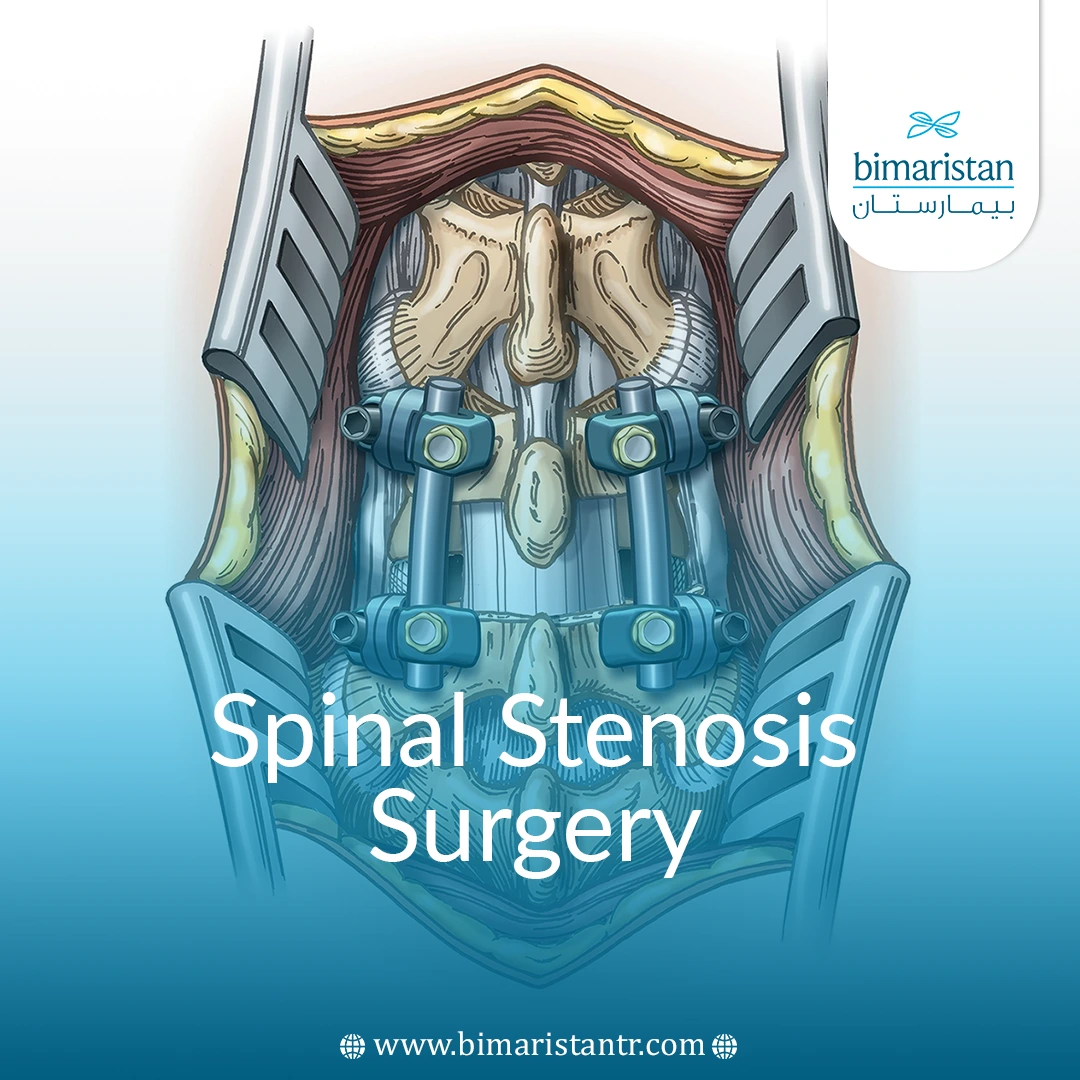 Spinal Stenosis Surgery in Turkey - Bimaristan