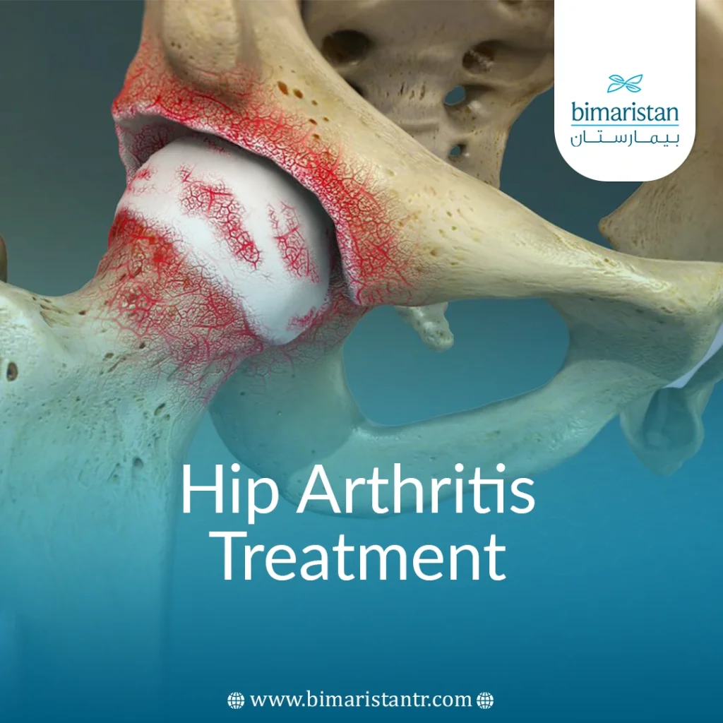 Hip Arthritis Treatment, A Solution for Joint Pain in Turkey