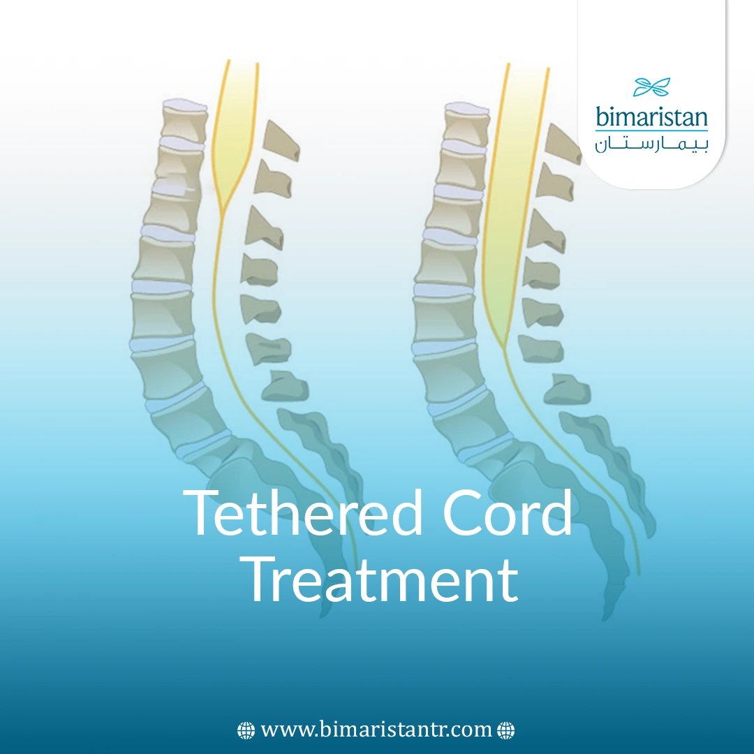 Tethered Cord Treatment in Turkey - Bimaristan
