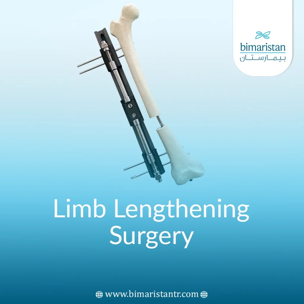 Limb Lengthening Surgery to Increase Height - Bimaristan