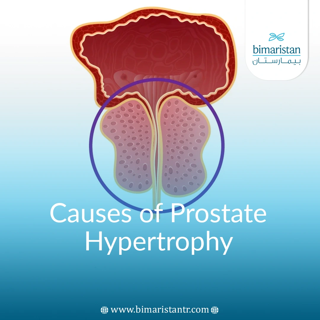 Causes of Prostate Hypertrophy at an Early Age - Bimaristan
