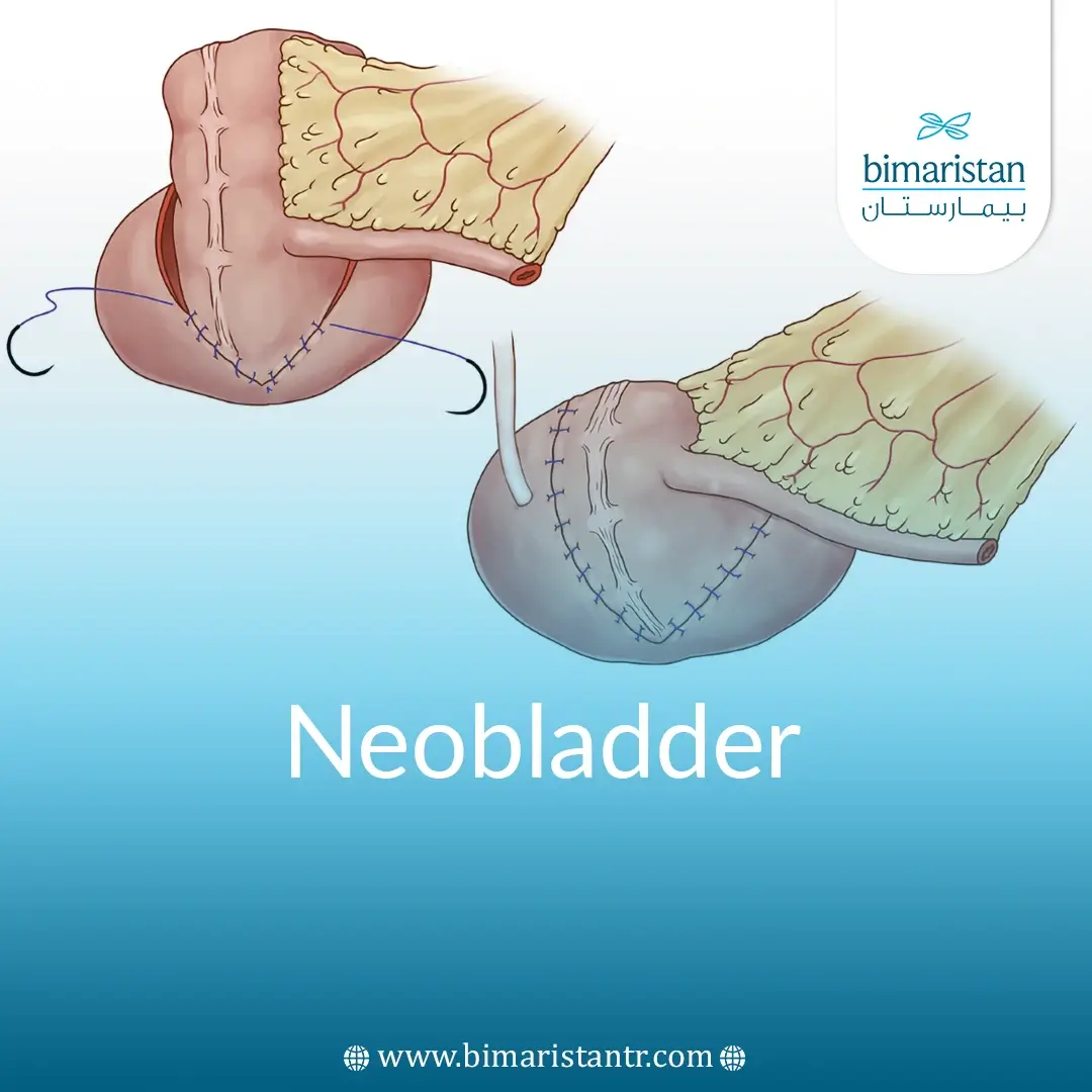 Bladder Reconstruction (Neobladder) in Turkey - Bimaristan