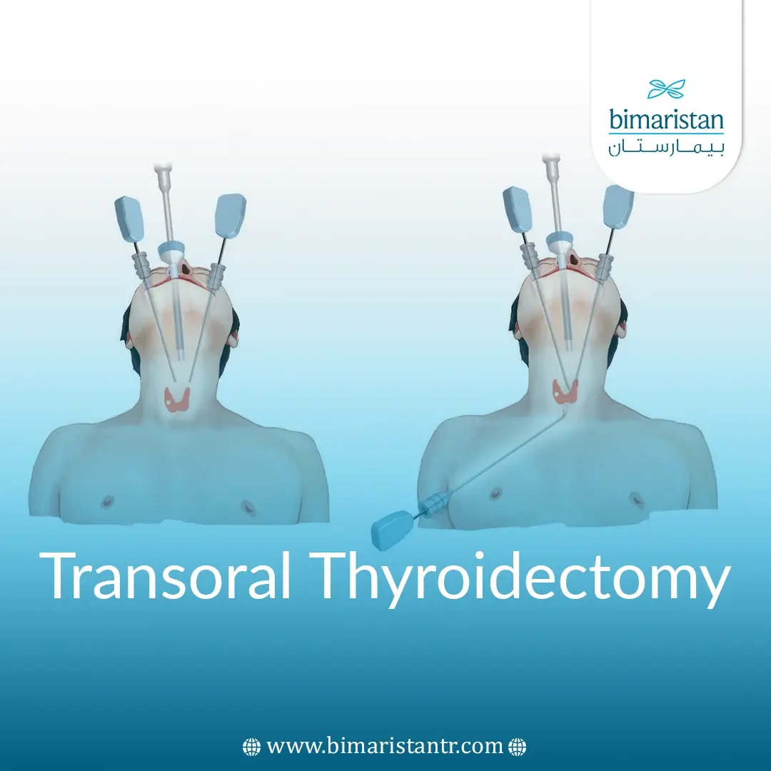 Laparoscopic Transoral Thyroidectomy - Bimaristan