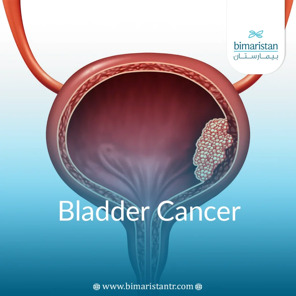 Bladder Cancer: Symptoms & Treatment in Turkey - Bimaristan