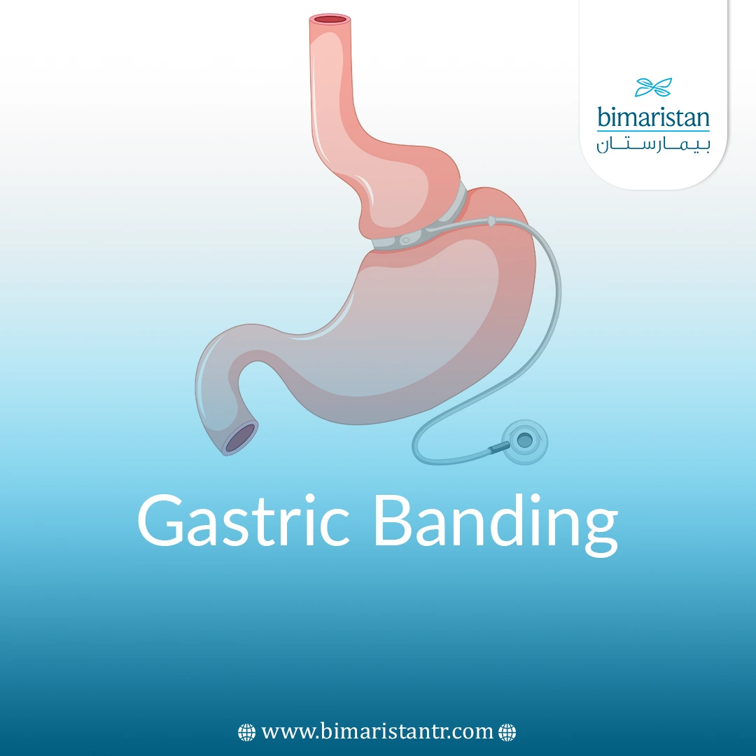 Laparoscopic Gastric Banding Surgery in Turkey - Bimaristan