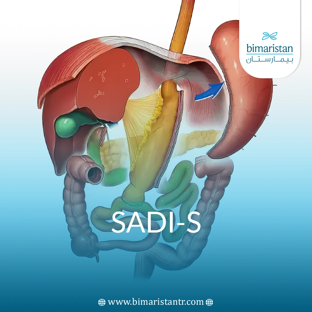 SADI-S Procedure in Turkey - Bimaristan