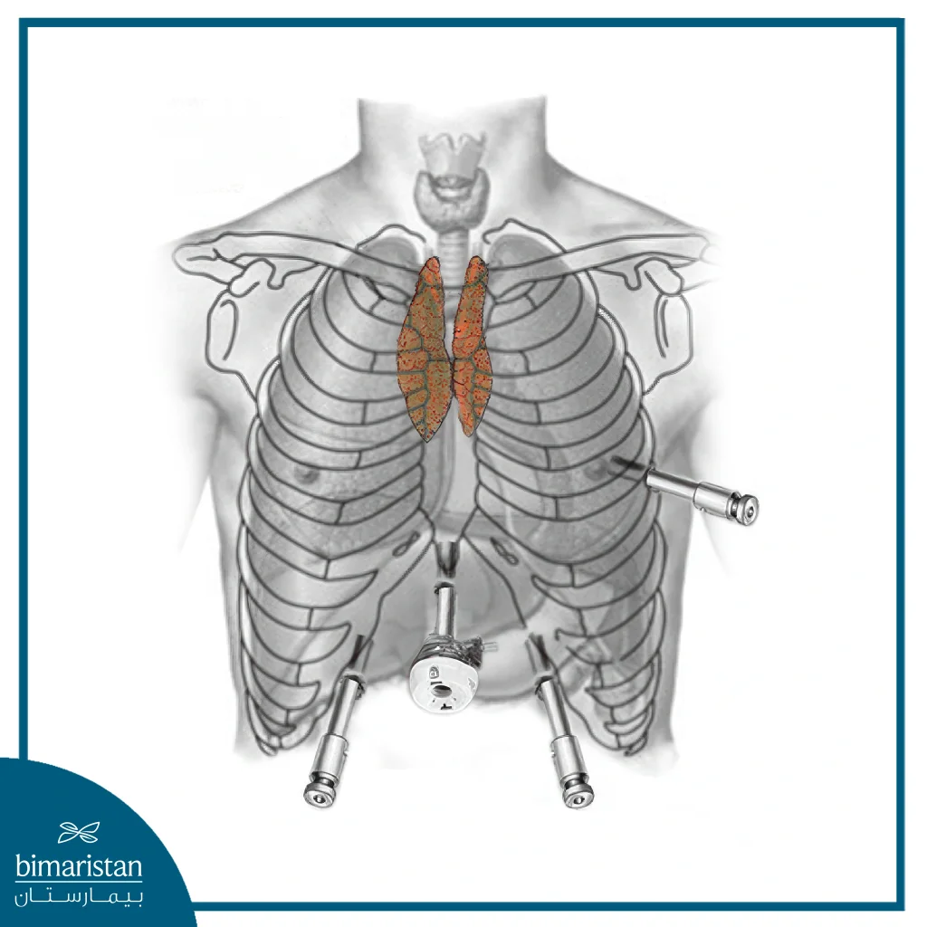 Robotic Thymectomy: Advanced Minimally Invasive Treatment